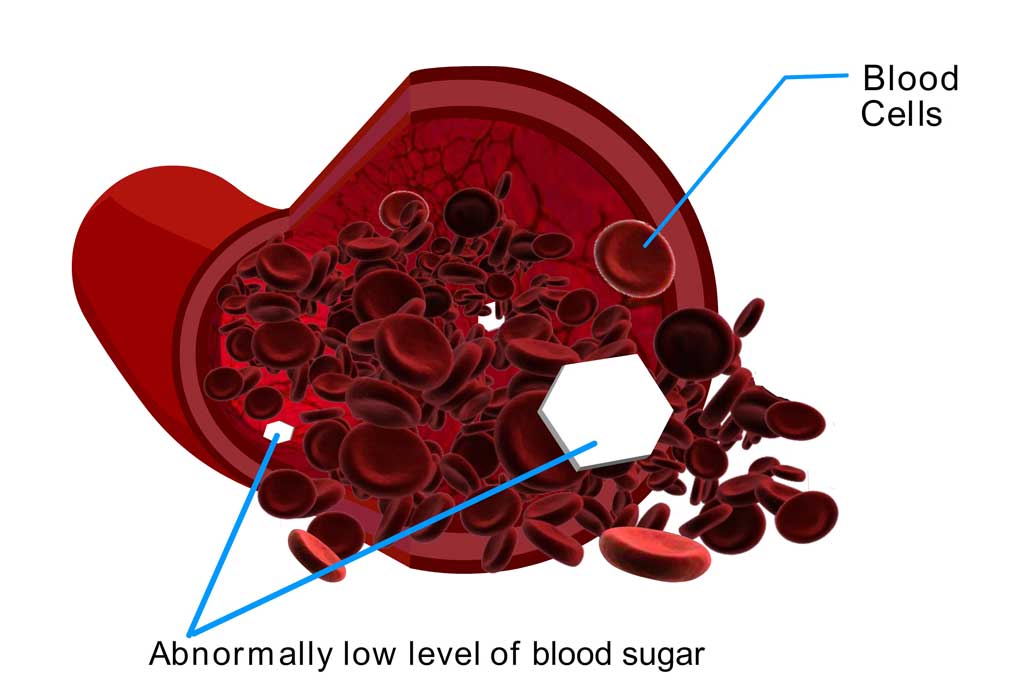What is Diabetic Hypoglycemia - Cause, Symptom, Treatment, Prevention ...