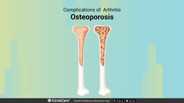 What are the complications caused by Arthritis? | CircleCare