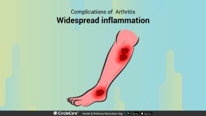 What are the complications caused by Arthritis? | CircleCare