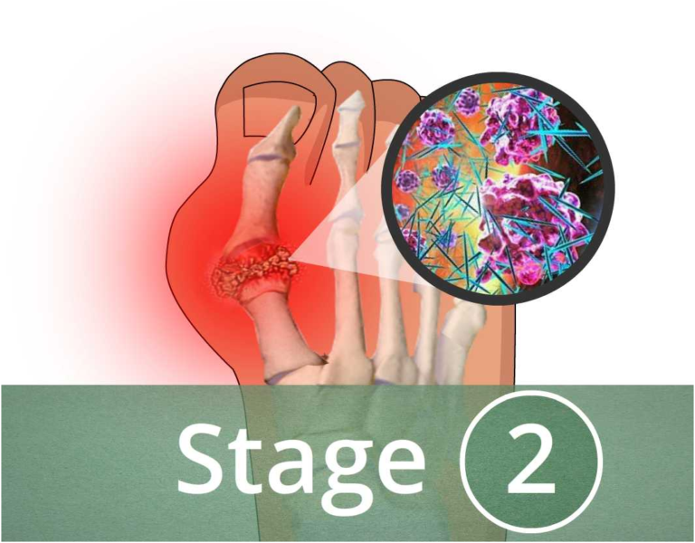 What are the 4 stages of gout? | CircleCare