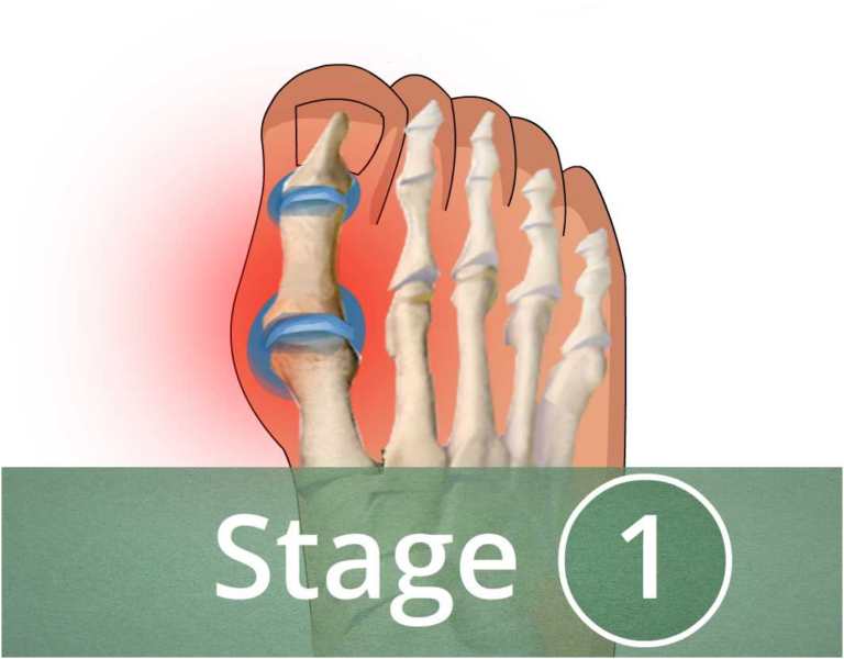 What are the 4 stages of gout? | CircleCare