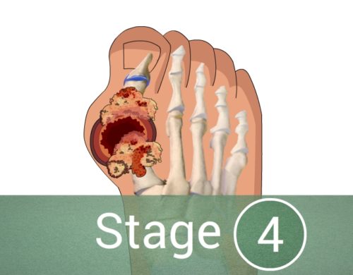 What are the 4 stages of gout? | CircleCare