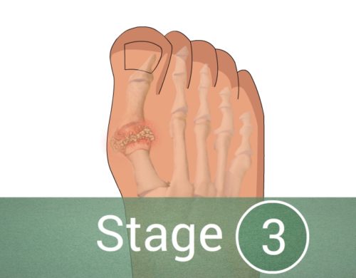 What are the 4 stages of gout? | CircleCare