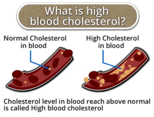 What-is-high-blood-cholesterol-circlecare - CircleCare