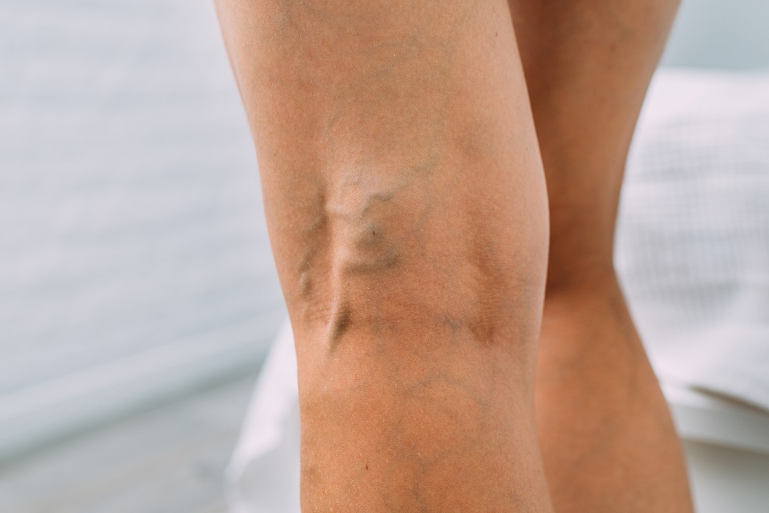 Varicose and Spider Veins: Causes, Symptoms, and Treatments - CircleCare